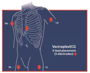 VectraplexECG