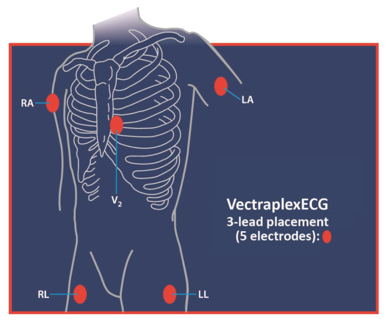 VectraplexECG