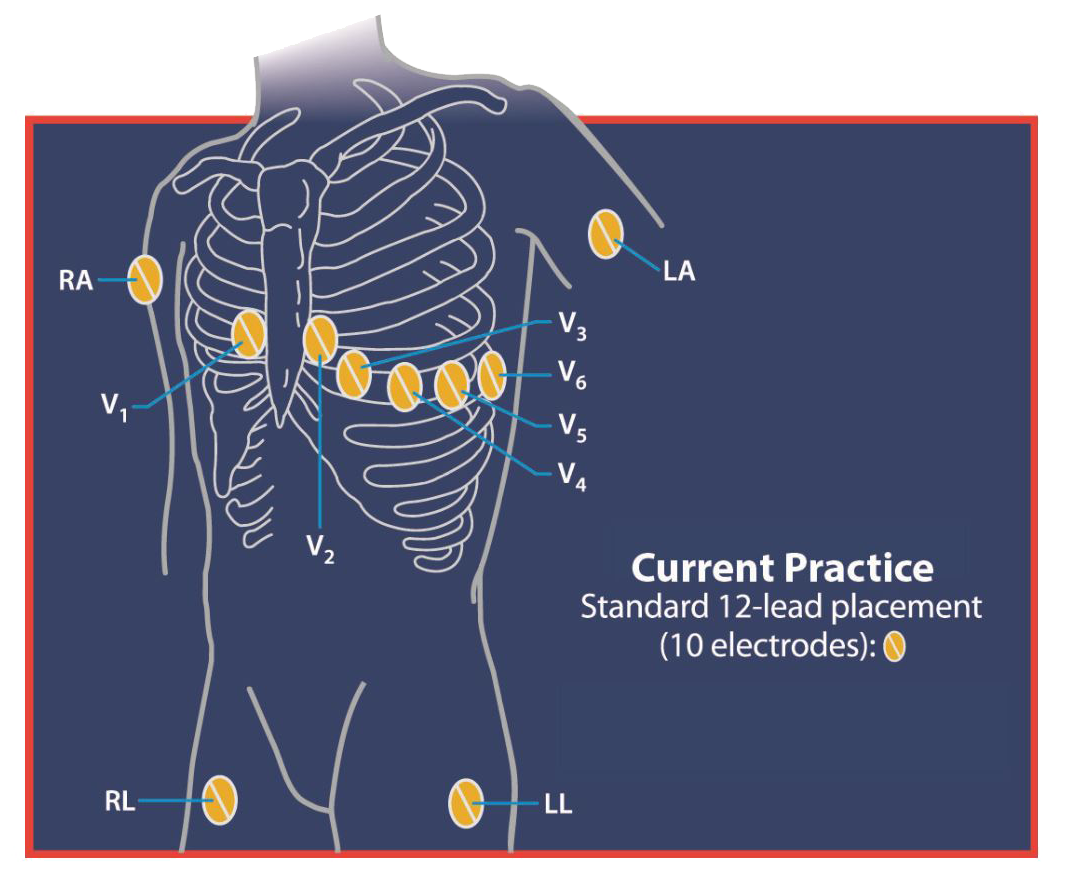 ECG